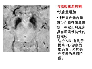 swallow tail sign | PPT | Brain and Nervous System Disorders | Diseases ...