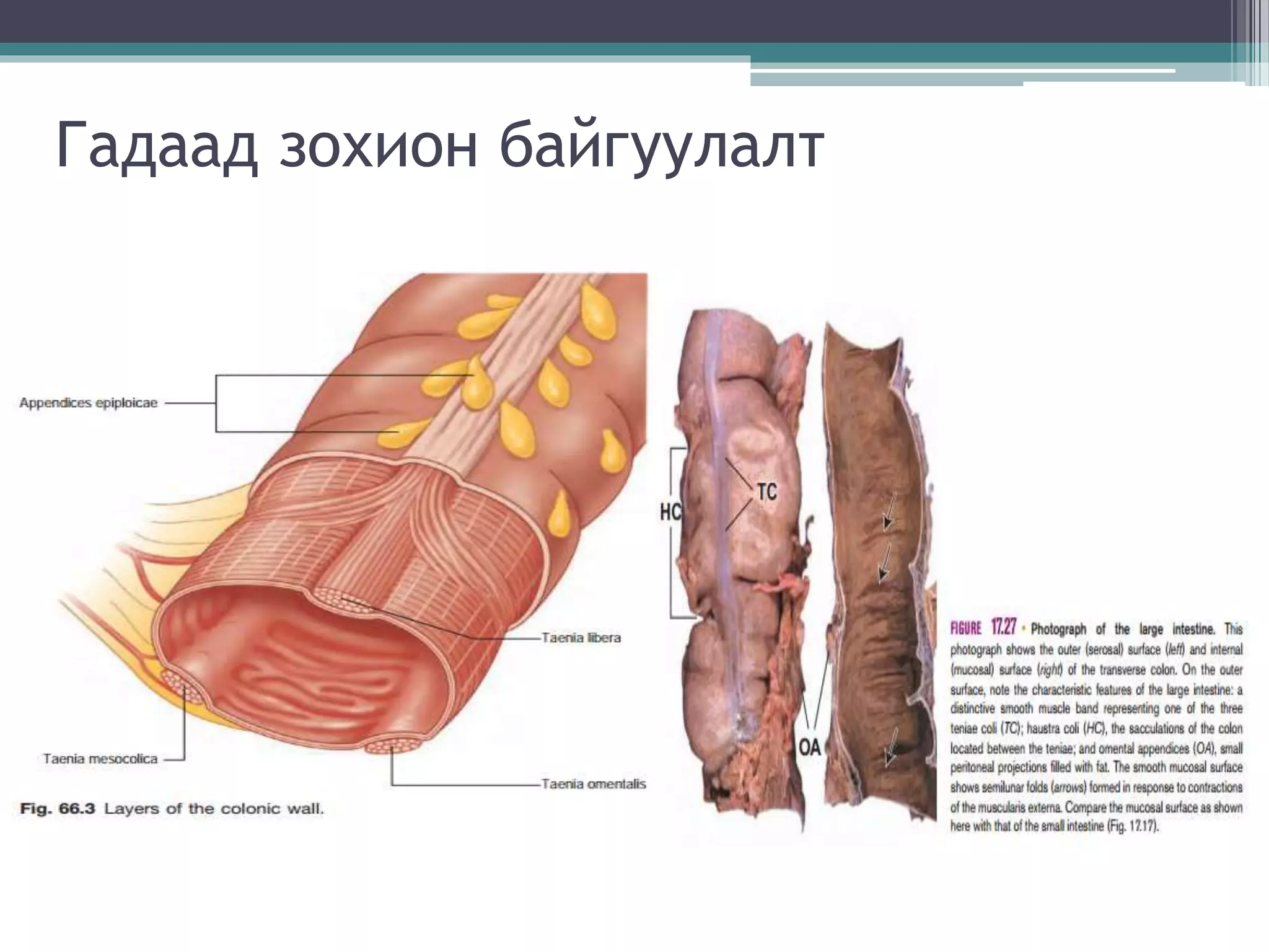 Бүдүүн гэдэсний хорт хавдар Pptx