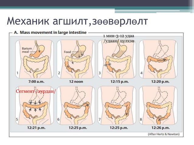 Бүдүүн гэдэсний хорт хавдар Pptx