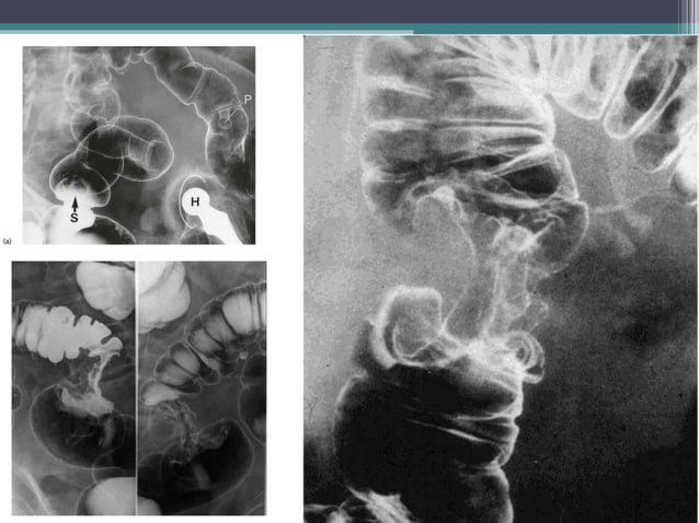 Бүдүүн гэдэсний хорт хавдар Pptx