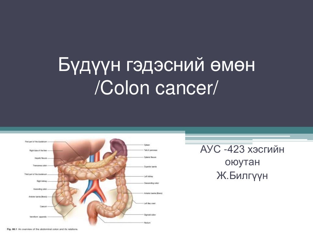 Бүдүүн гэдэсний хорт хавдар