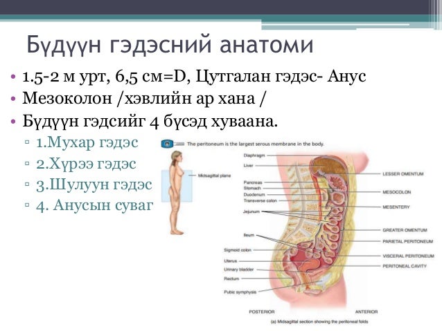 Бүдүүн гэдэсний хорт хавдар