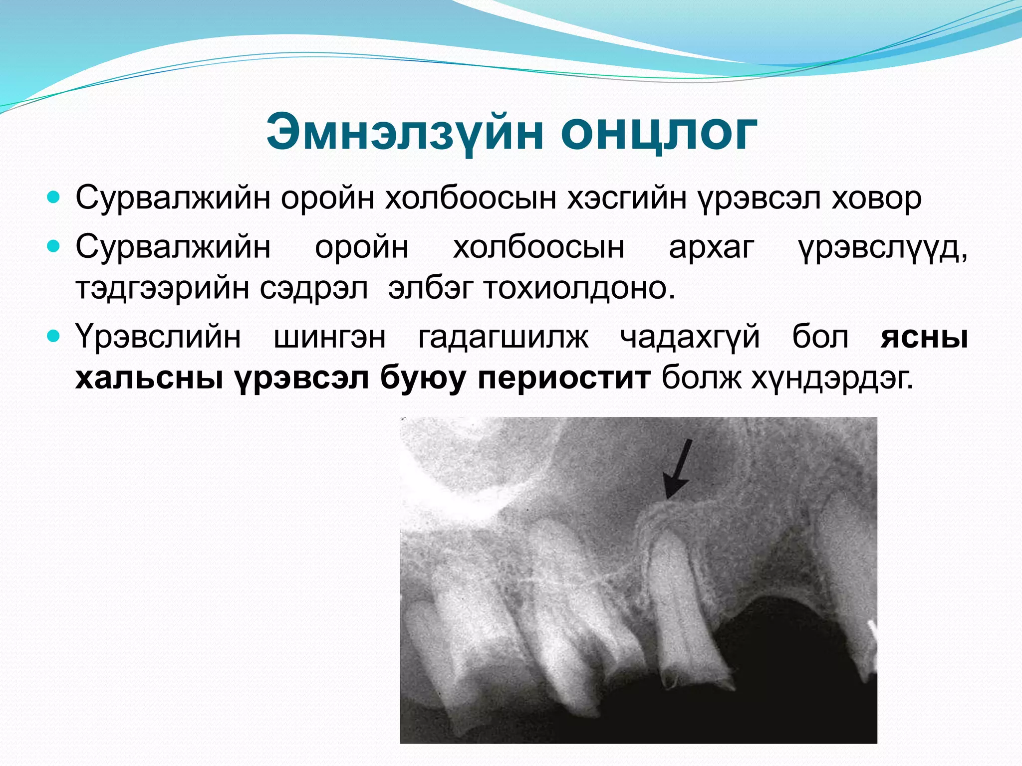 Сүүн шүдний сурвалжийн оройн холбоосын үрэвслийн шалтгаан, | PPTX