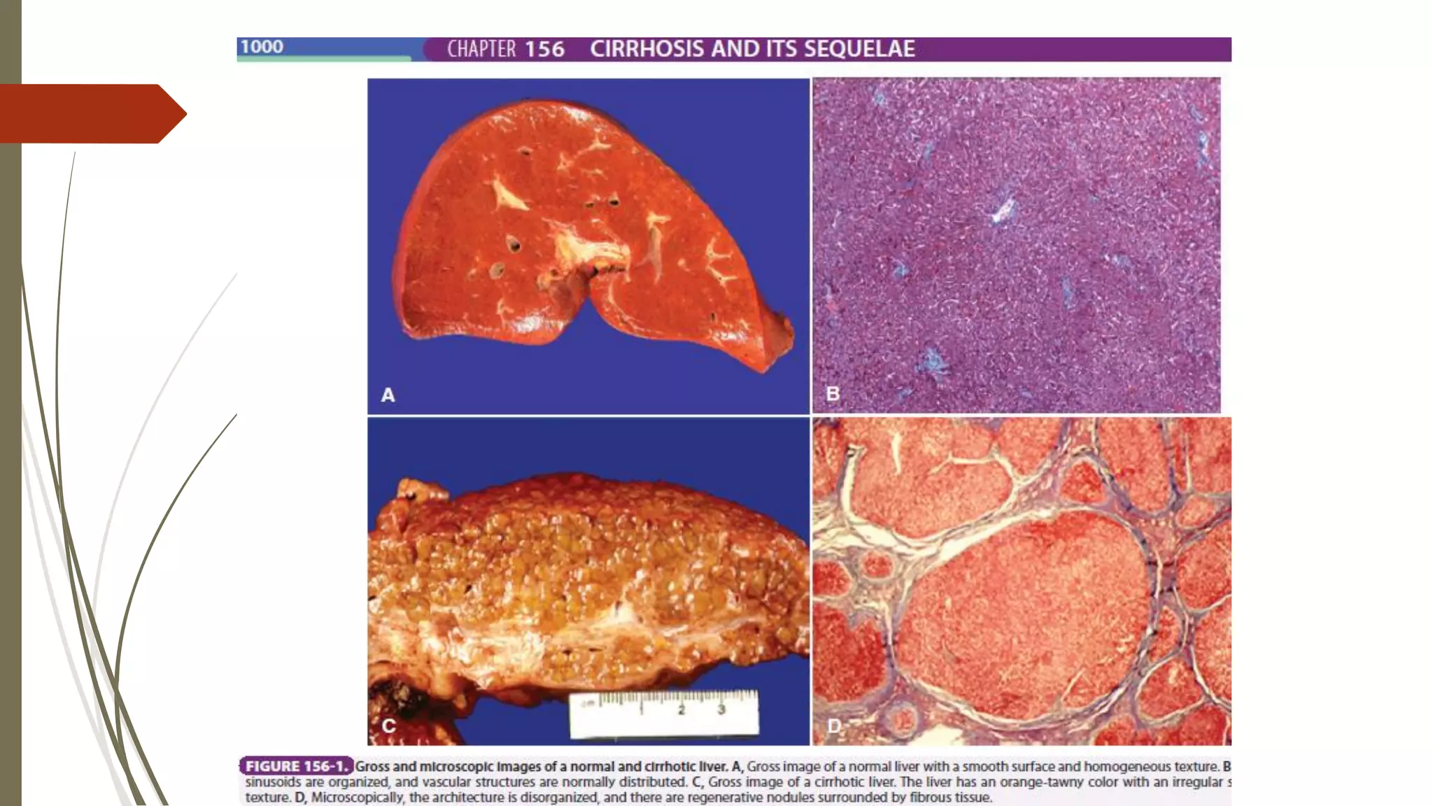 liver cirrhosis | PDF