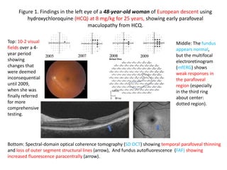Hydroxychloroquine retinopathy screening guidelines | PPTX