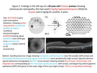 Hydroxychloroquine retinopathy screening guidelines | PPTX