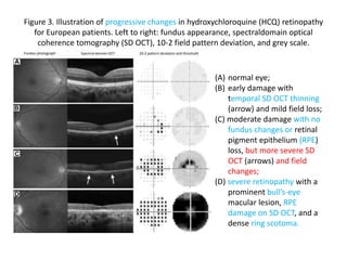 Hydroxychloroquine retinopathy screening guidelines | PPTX