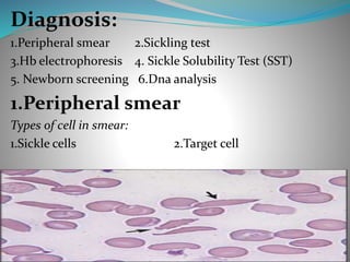 sickel cell anemia | PPTX