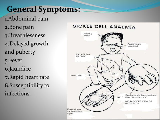 sickel cell anemia | PPTX