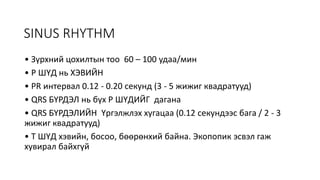 синусын брадикарди | PPTX