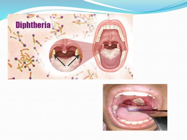 Epidemiology and nursing management of communicable disease - DIPHTHERIA | PPT
