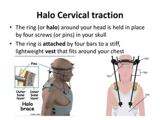 Halo Vest Orthosis