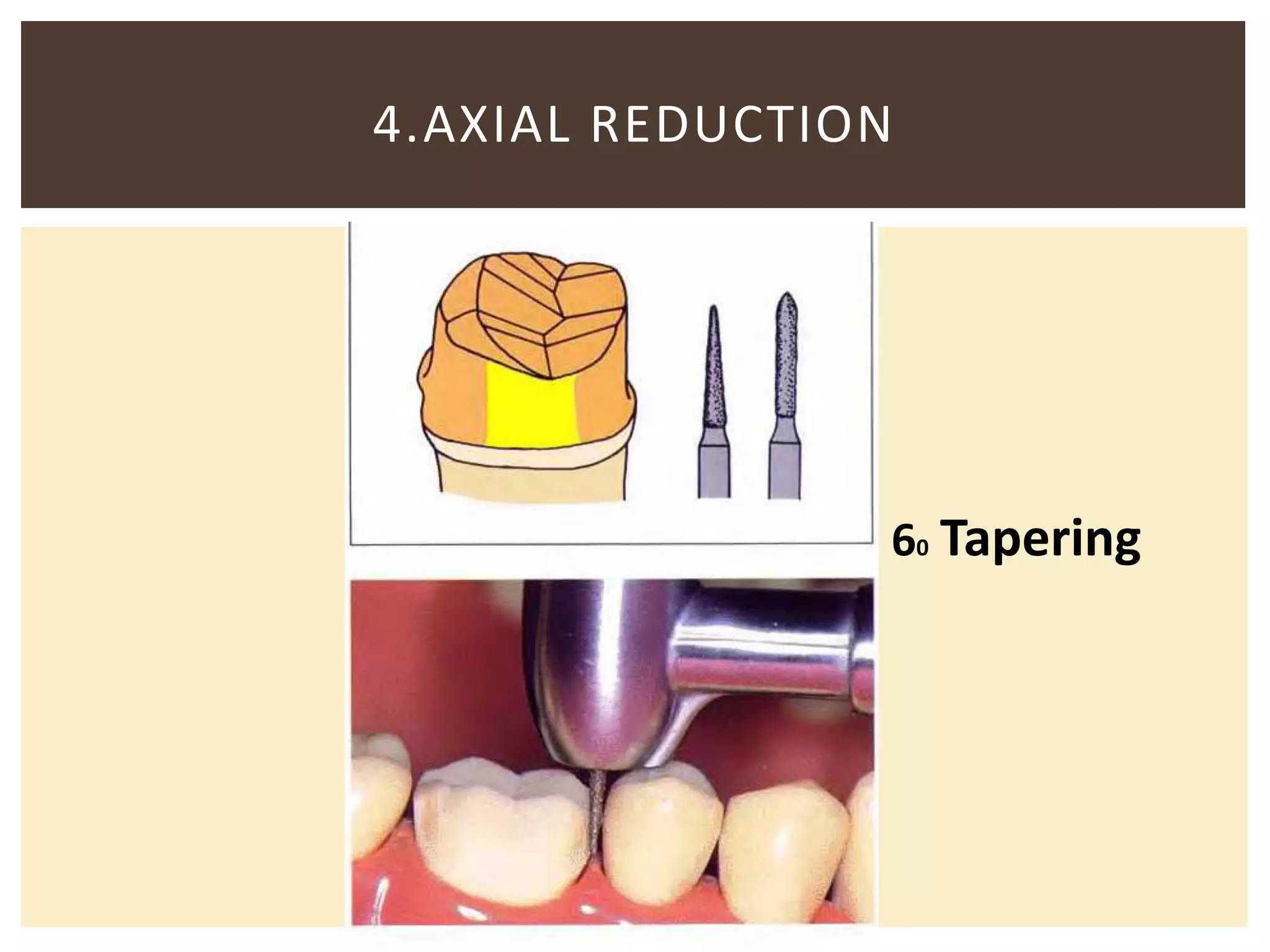 Basic Principles of crowns & bridges | PPTX