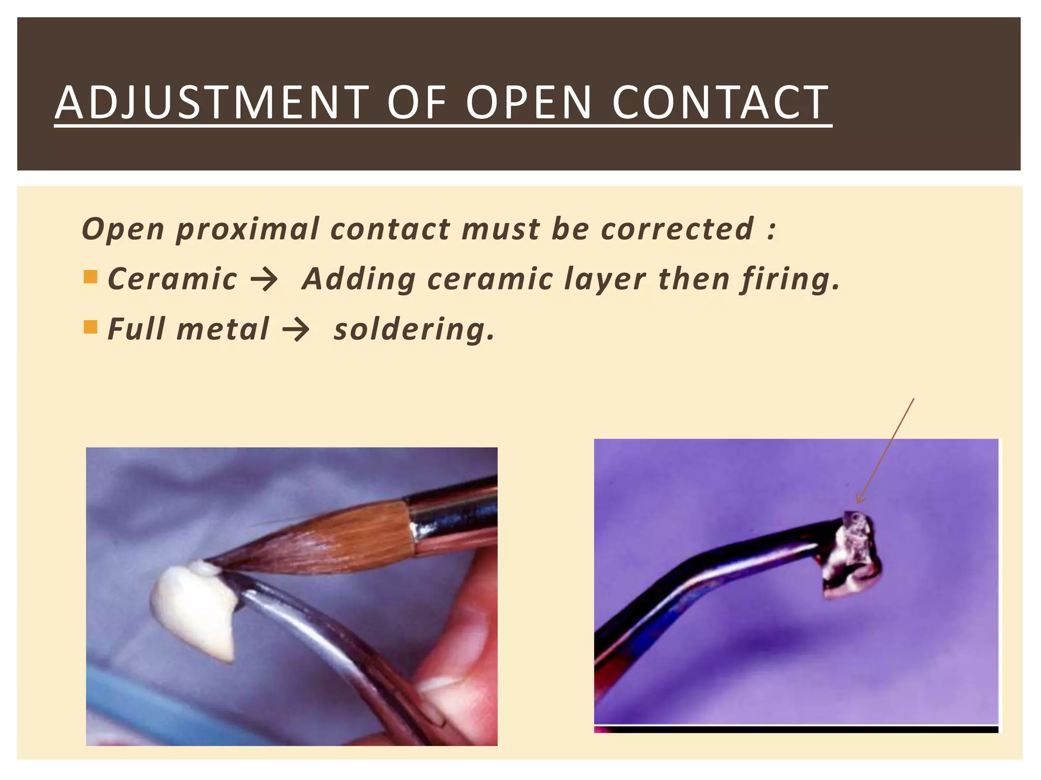 Basic Principles of crowns & bridges | PPTX