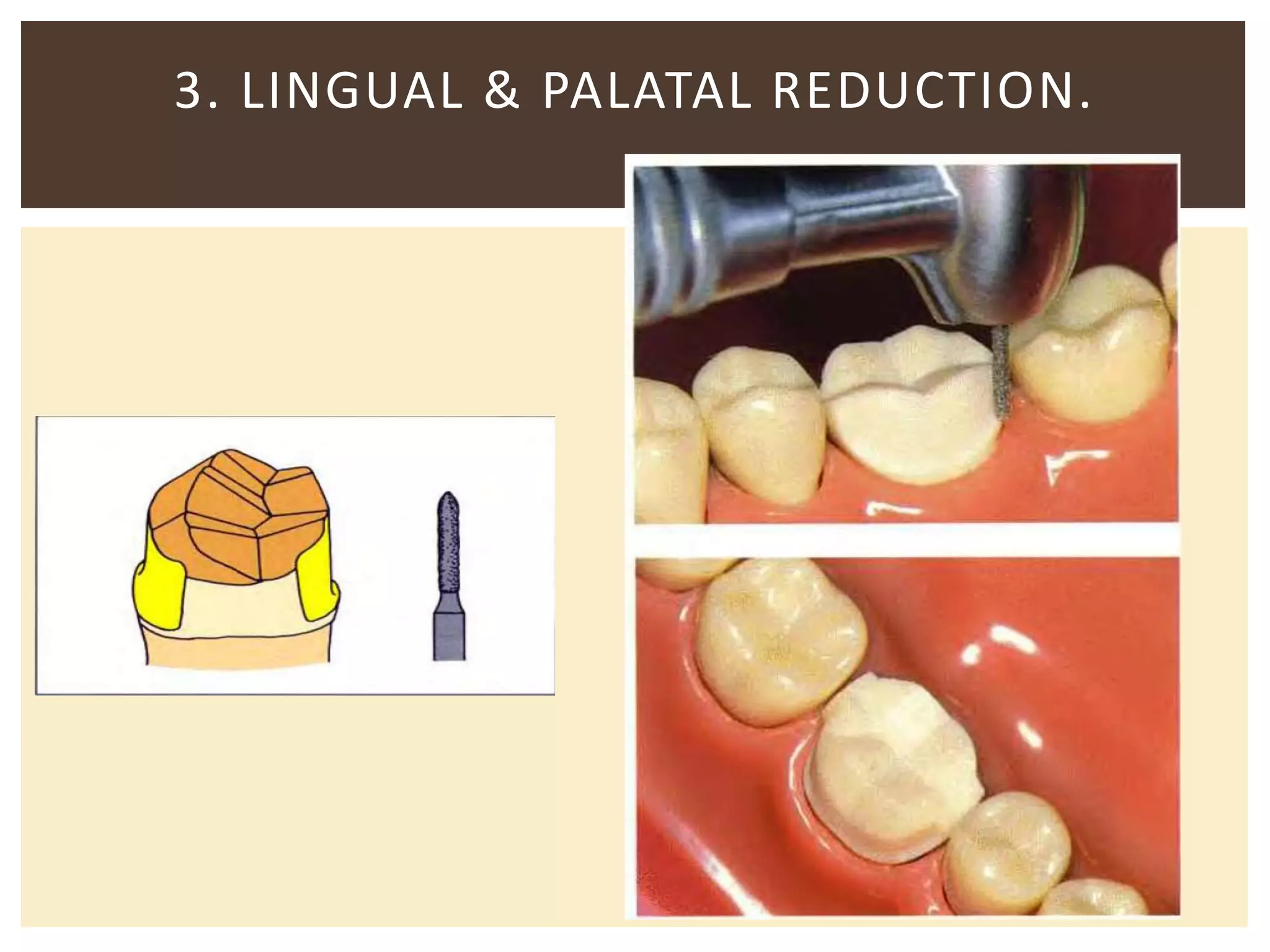 Basic Principles of crowns & bridges | PPTX
