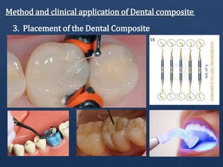 Dental Composite | PPTX