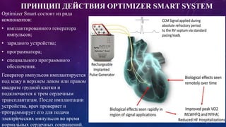 ресинхронизирующая терапия (устройства) | PPT