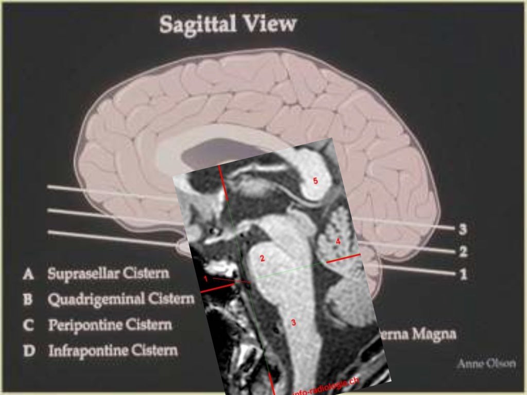 Anatomical Radiological Integrated Course: PART I: Subarachnoid Ciste…