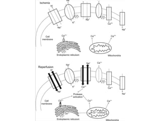Классификация ишемий при АН.pptx