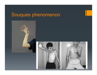 .stroke physiotherapy.pptx | Physical Therapy | Wellness