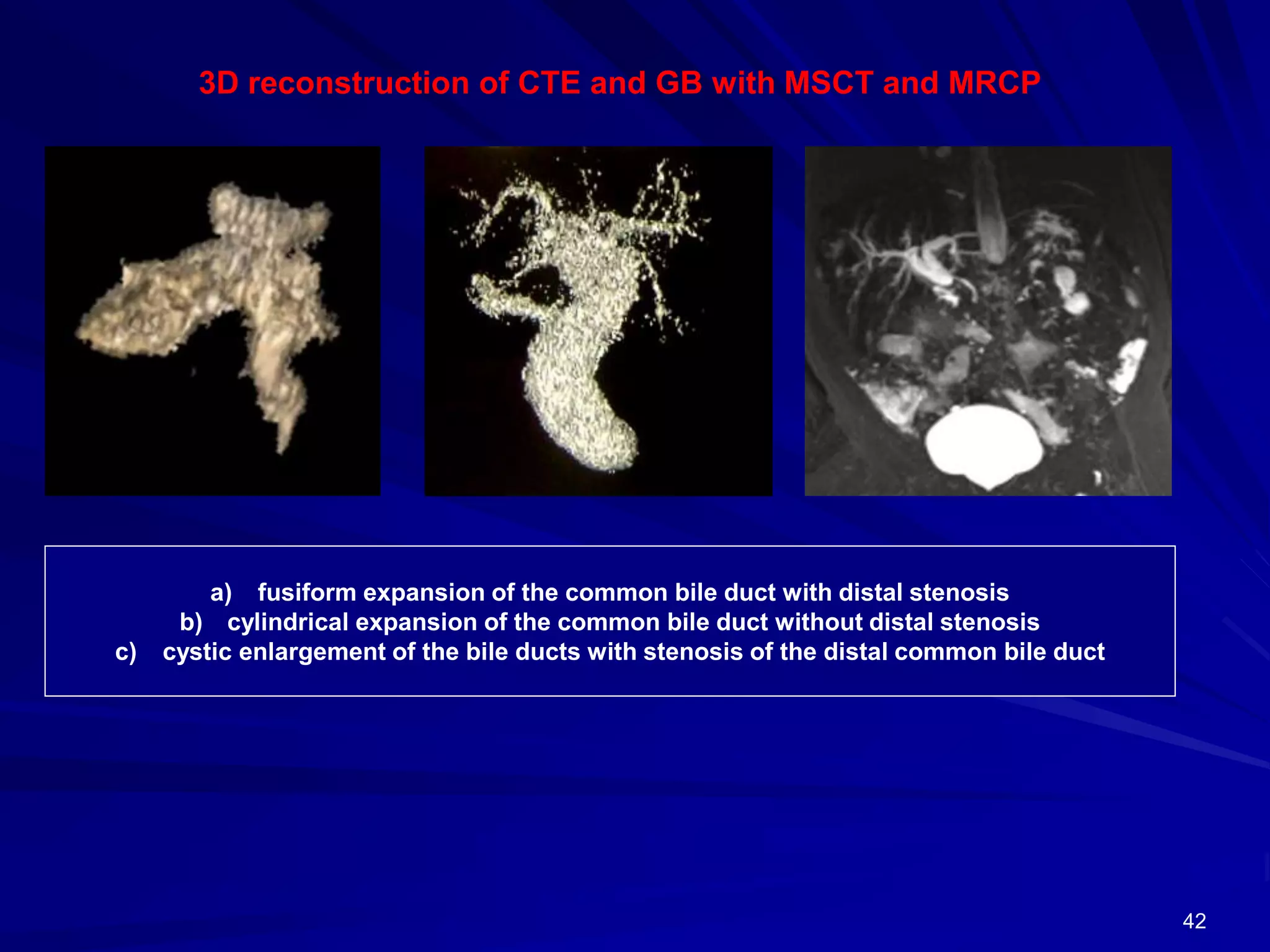 Malformations of the biliary tract. Portal hypertension syndrome ...