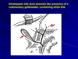 Malformations of the biliary tract. Portal hypertension syndrome ...