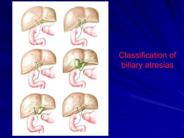 Malformations of the biliary tract. Portal hypertension syndrome ...