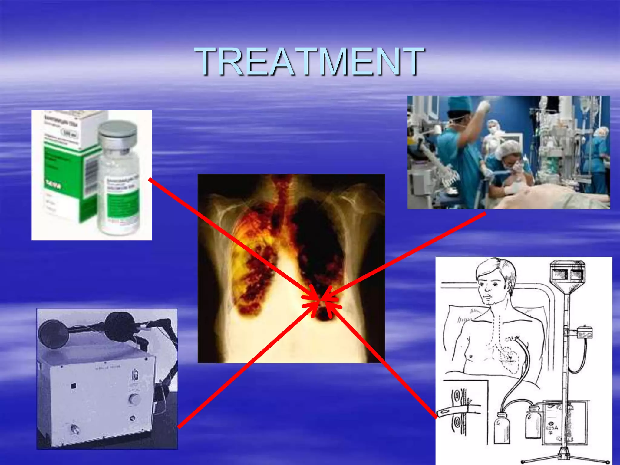 Лекция. Абсцесс и гангрена легких. Abscess, lung gangrene англ..ppt