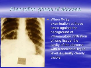 Лекция. Абсцесс и гангрена легких. Abscess, lung gangrene англ..ppt