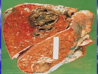 Лекция. Абсцесс и гангрена легких. Abscess, lung gangrene англ..ppt