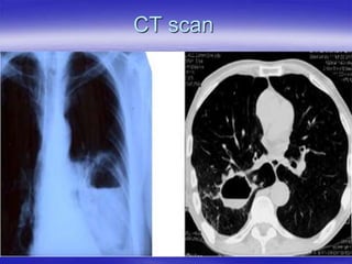 Лекция. Абсцесс и гангрена легких. Abscess, lung gangrene англ..ppt