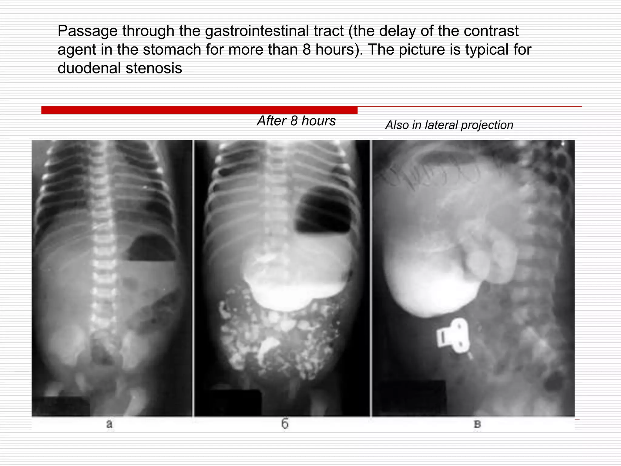 Intussusception | PPT