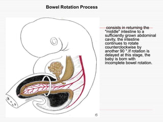 Intussusception | PPT