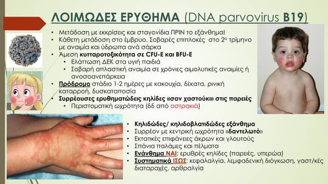 Συνεδρία Λοιμώξεων - Εξανθήματα στα Λοιμώδη Νοσήματα στα Παιδιά | PDF