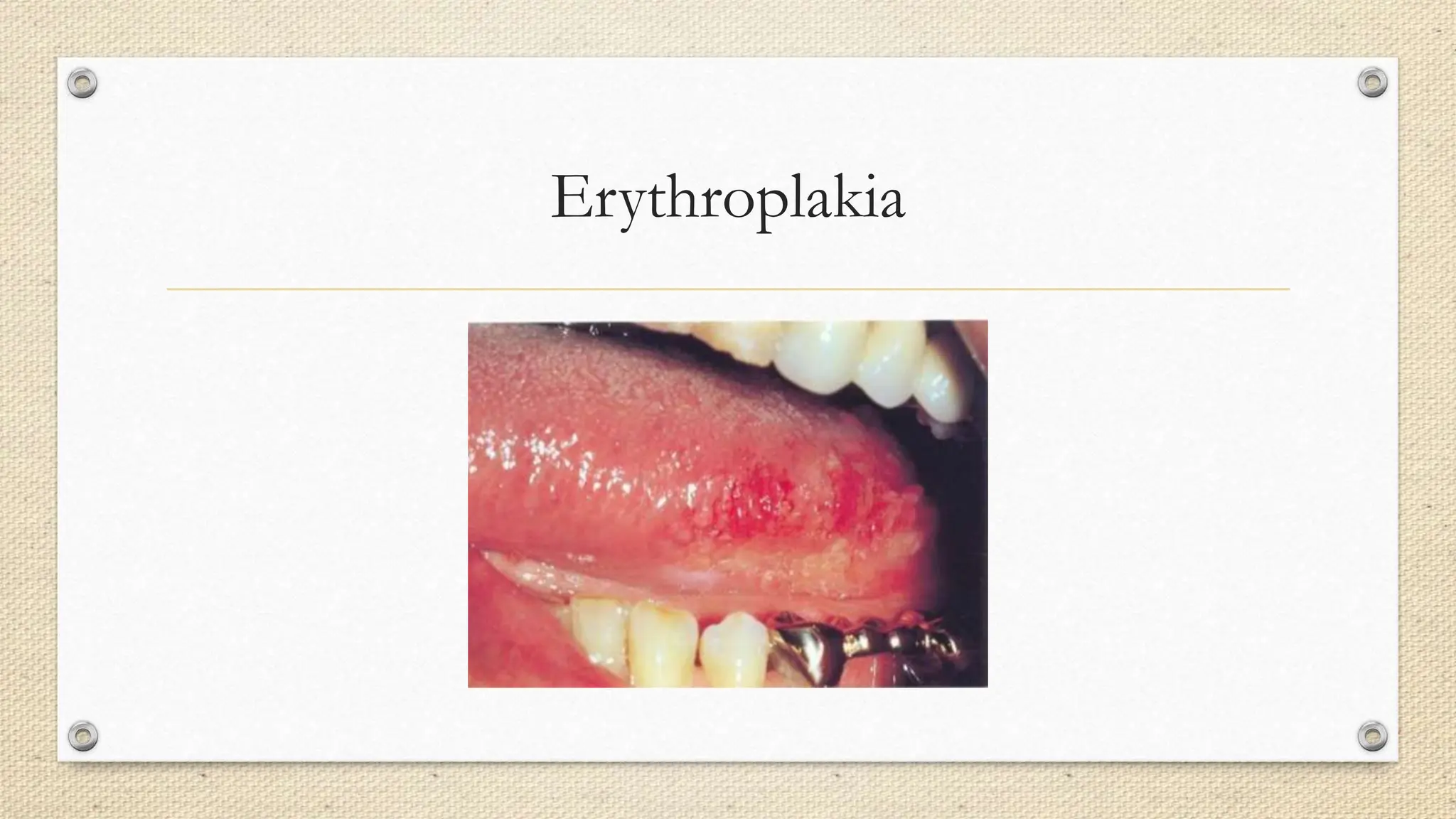 اریترو لوکو.pptx dentistry erythroplakia | PPT