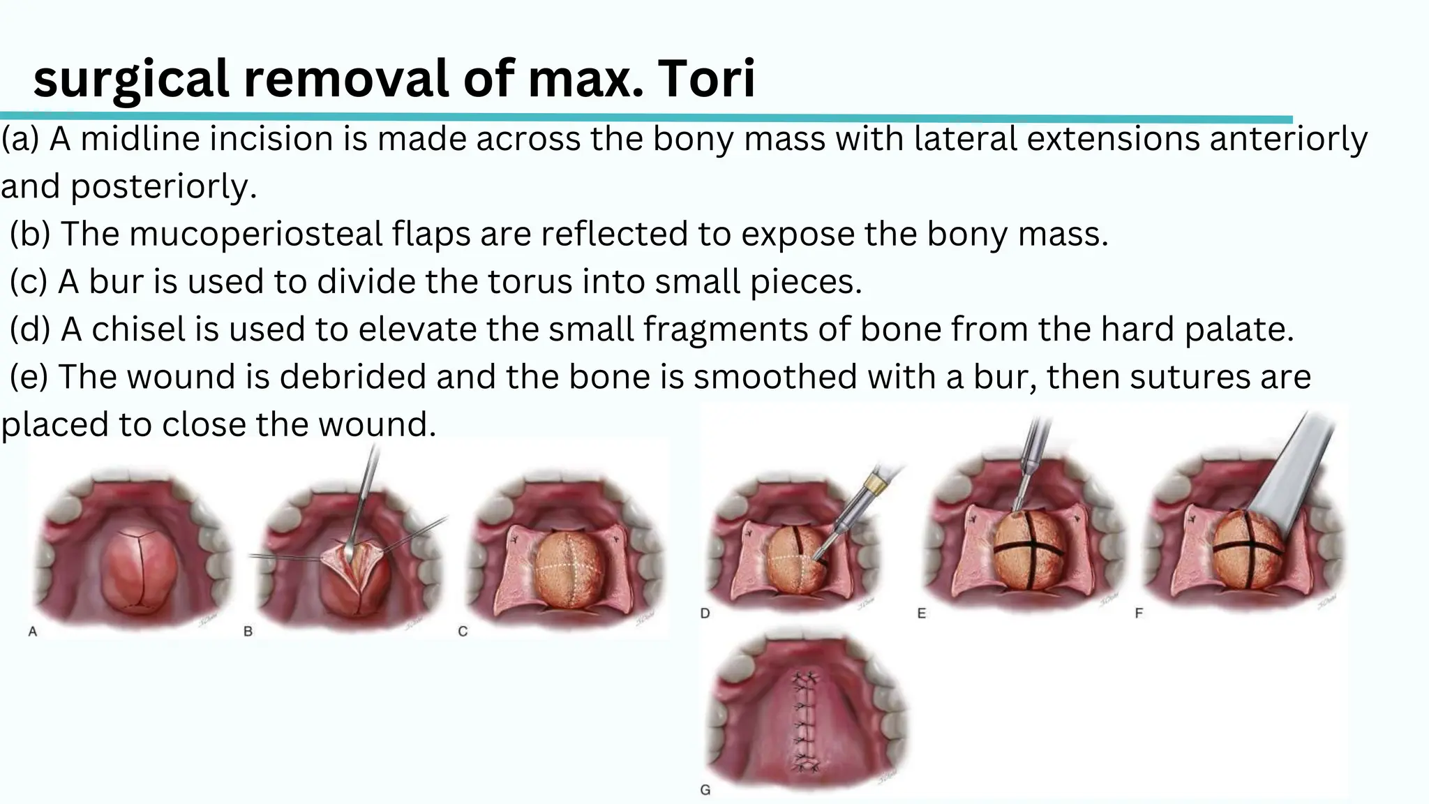 Tori palatinus , tori madibularis and treatment | PPTX
