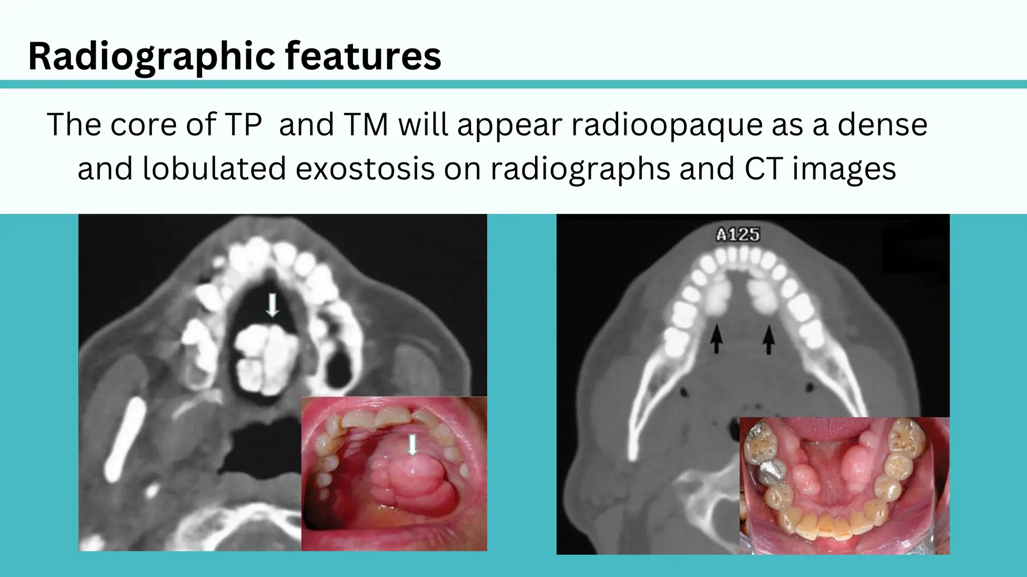 Tori palatinus , tori madibularis and treatment | PPTX | Dental Health ...
