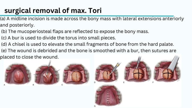 Tori palatinus , tori madibularis and treatment | PPTX | Dental Health ...