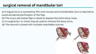 Tori palatinus , tori madibularis and treatment | PPTX