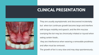 Tori palatinus , tori madibularis and treatment | PPTX