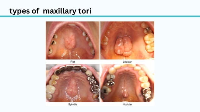 Tori palatinus , tori madibularis and treatment | PPTX | Dental Health | Diseases and Conditions