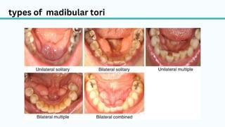 Tori palatinus , tori madibularis and treatment | PPTX
