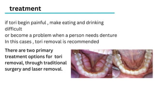 Tori palatinus , tori madibularis and treatment | PPTX