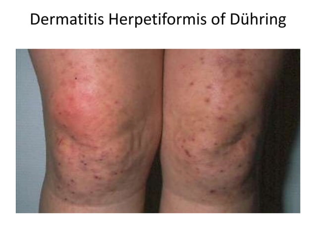 лекция.pptx for std dermatovenerology, cause and symptoms | PPT | Free ...