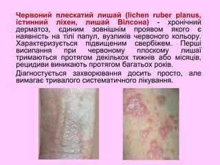Червоний плескатий лишай лекція дерматологія | PPT