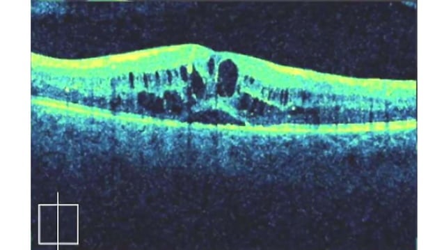 OCT and OCTA in DR practical discussions | PPT