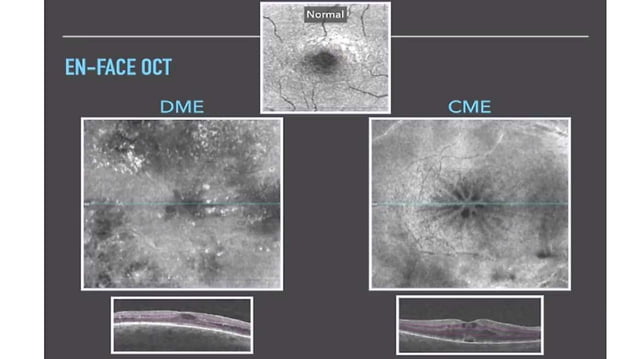 OCT and OCTA in DR practical discussions | PPT