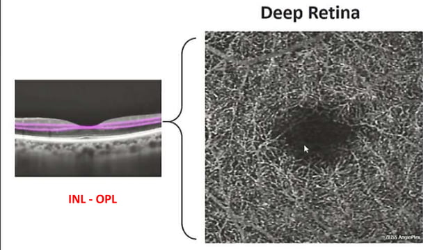 OCT and OCTA in DR practical discussions | PPT