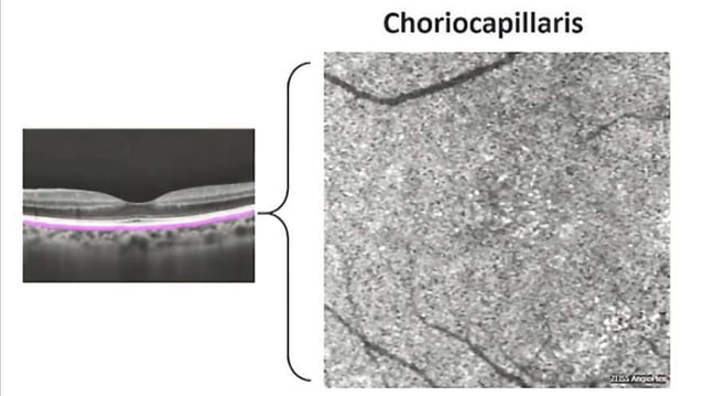 OCT and OCTA in DR practical discussions | PPT