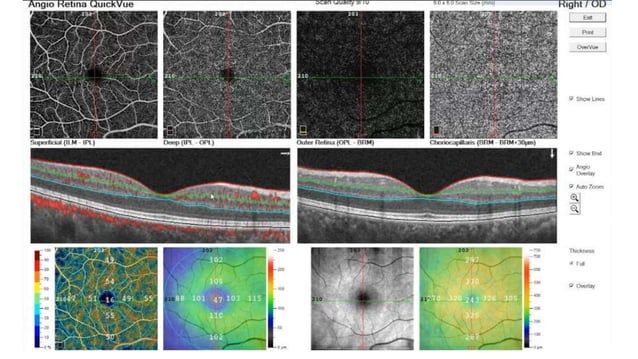 OCT and OCTA in DR practical discussions | PPT